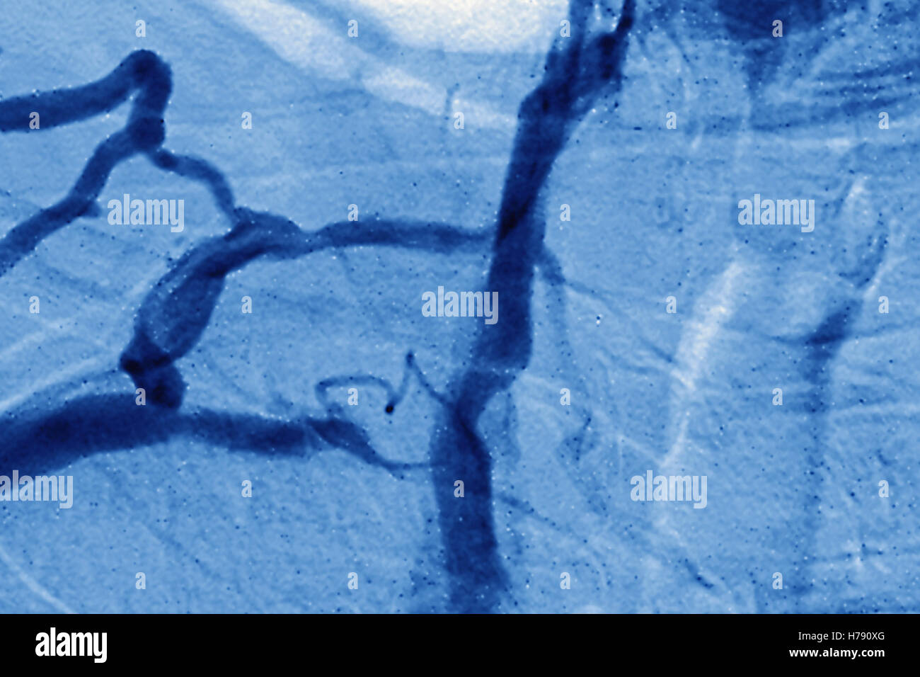 VENOUS STENOSIS, ANGIOGRAPHY Stock Photo - Alamy