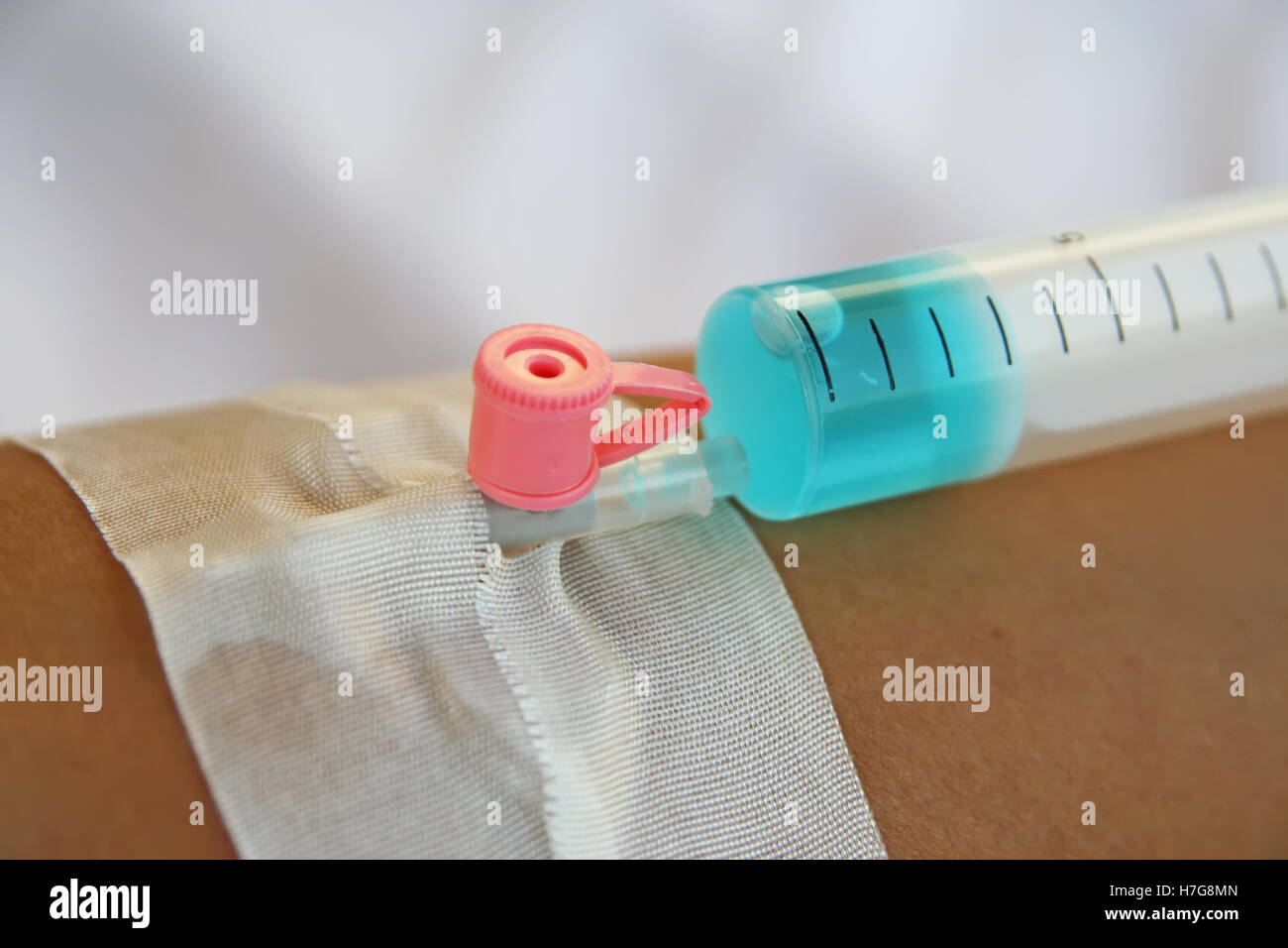 Intravenous infusion system. Intravenous medical therapy treatment ...