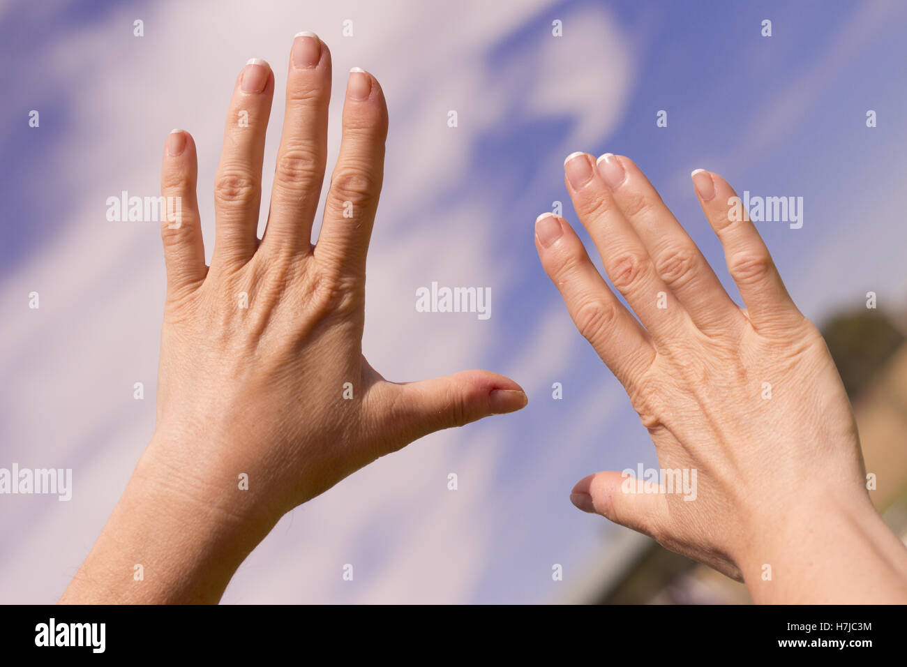 Hands of middle-aged woman deformed by arthritis Stock Photo - Alamy
