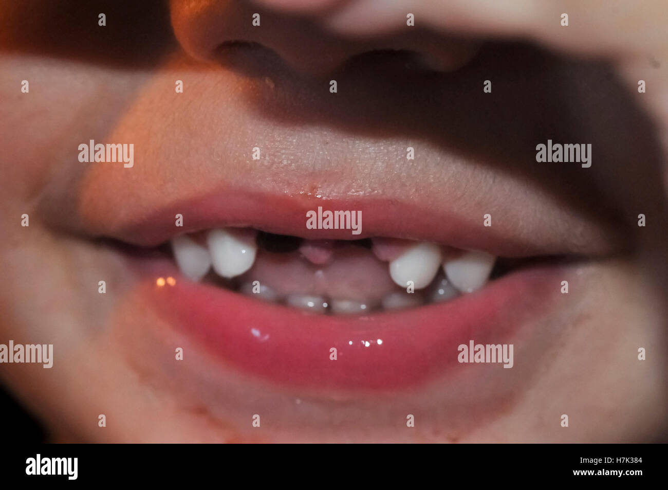 Two front teeth missing hi-res stock photography and images - Alamy