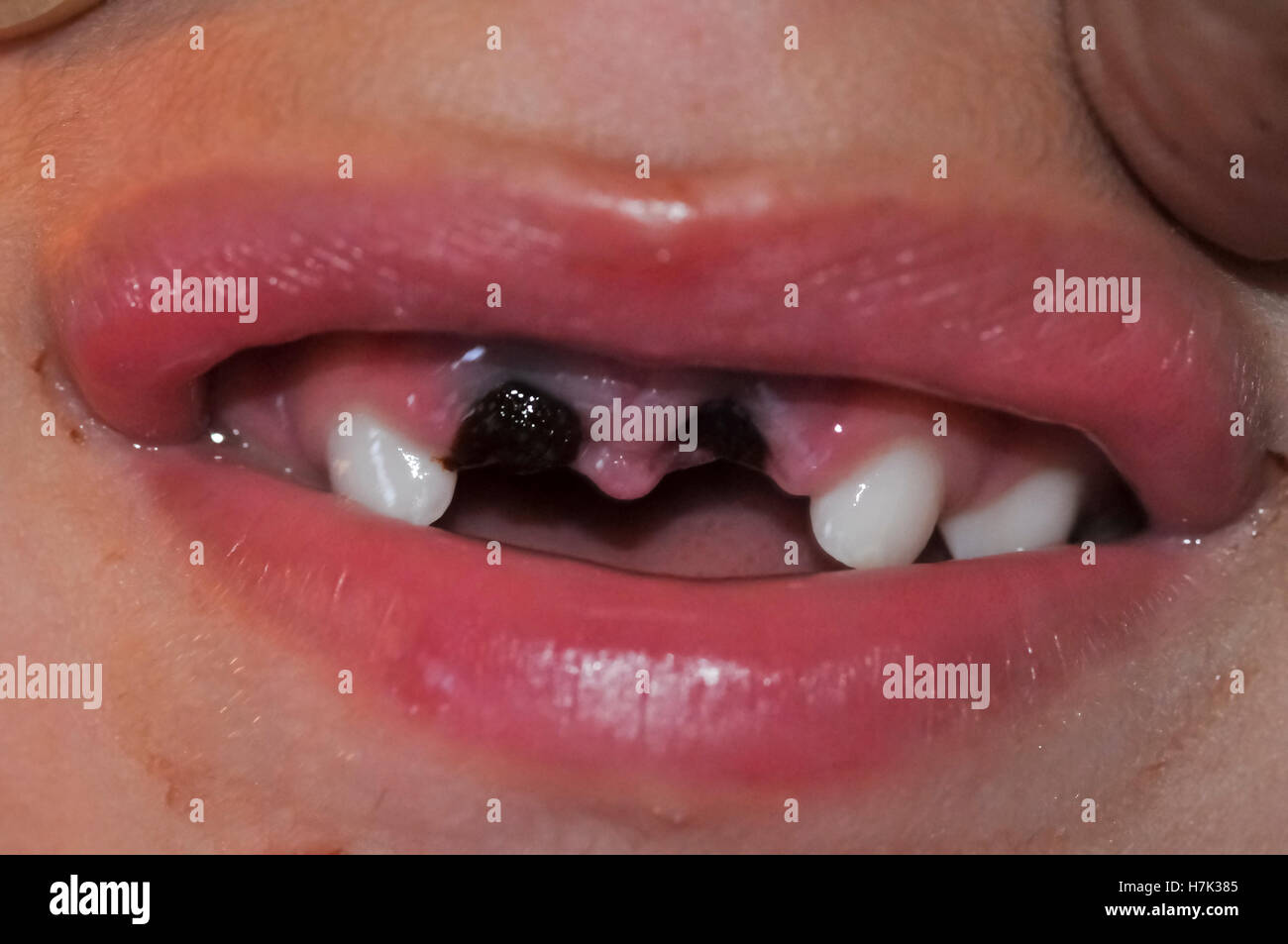Missing Baby Teeth High Resolution Stock Photography and Images - Alamy