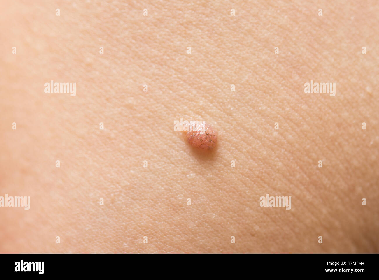 Skin cancer mole hi-res stock photography and images - Alamy