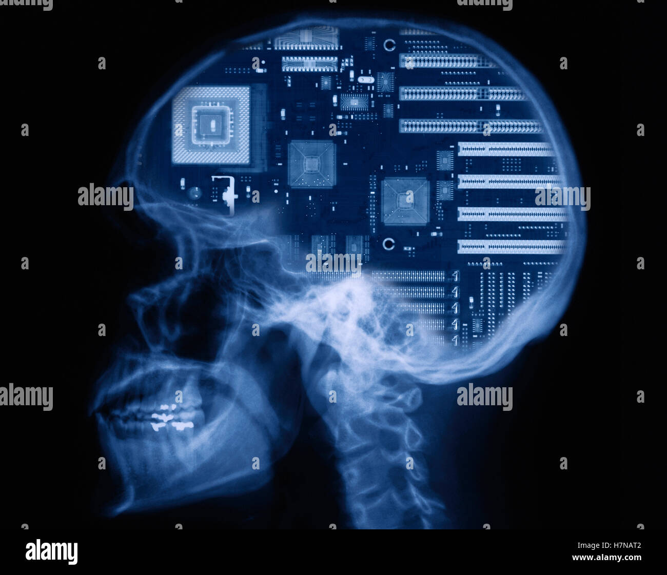 X-ray of human skull Stock Photo - Alamy