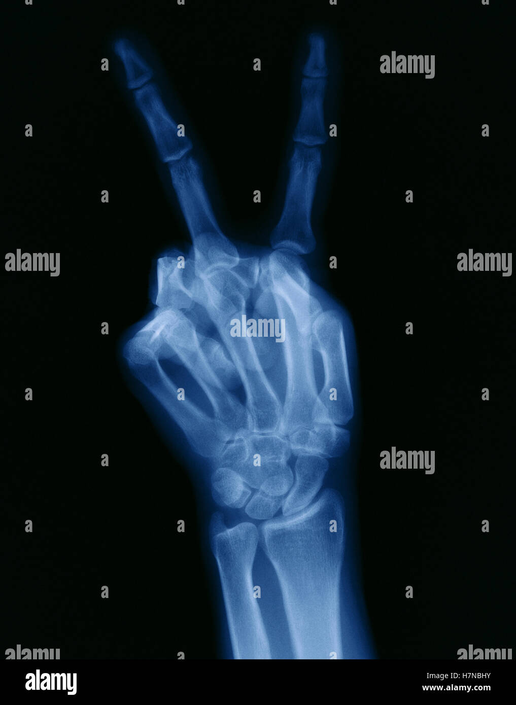 X-ray of hand making peace symbol Stock Photo - Alamy
