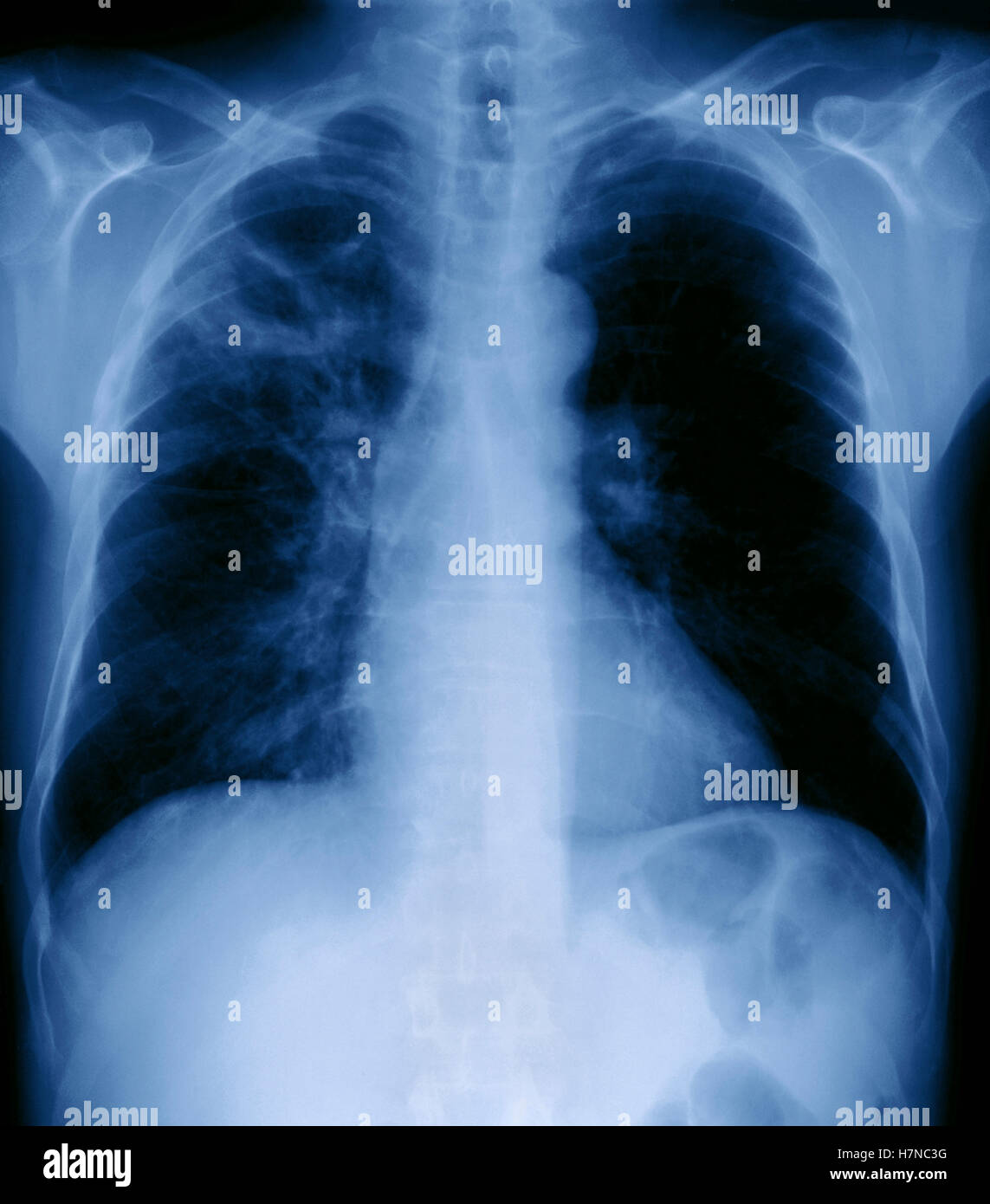 X-ray of human chest Stock Photo - Alamy