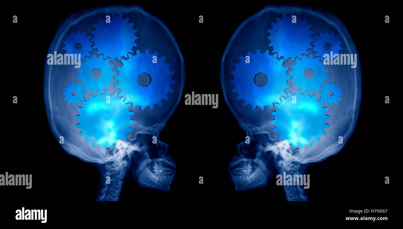 X-ray of inflated human skull with big brain Stock Photo - Alamy