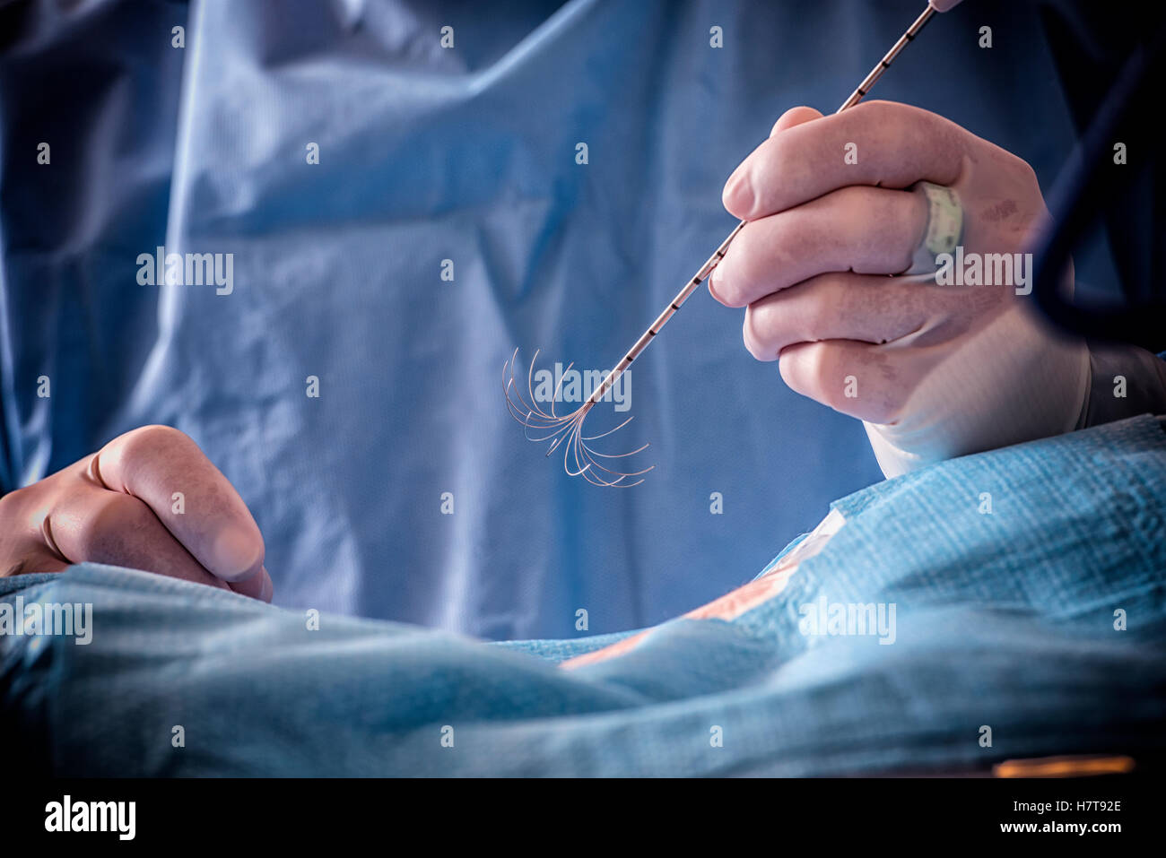 Radiofrquency ablation probe hi-res stock photography and images - Alamy
