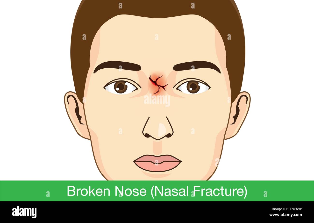 Broken Nose (Nasal Fracture) Age Groups And Types, Symptoms, Diagnosis ...