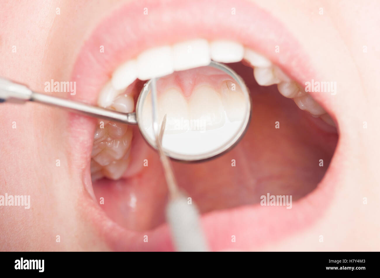 Close-up of dental inspection with hygienist mirror on white woman ...