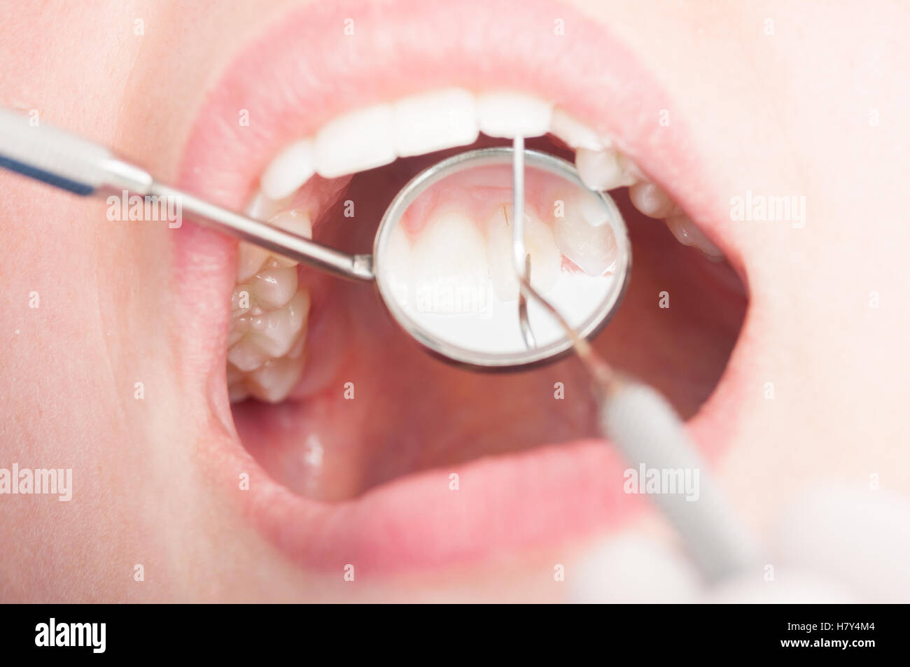 Close-up of dental inspection with orthodontist mirror on pretty white ...