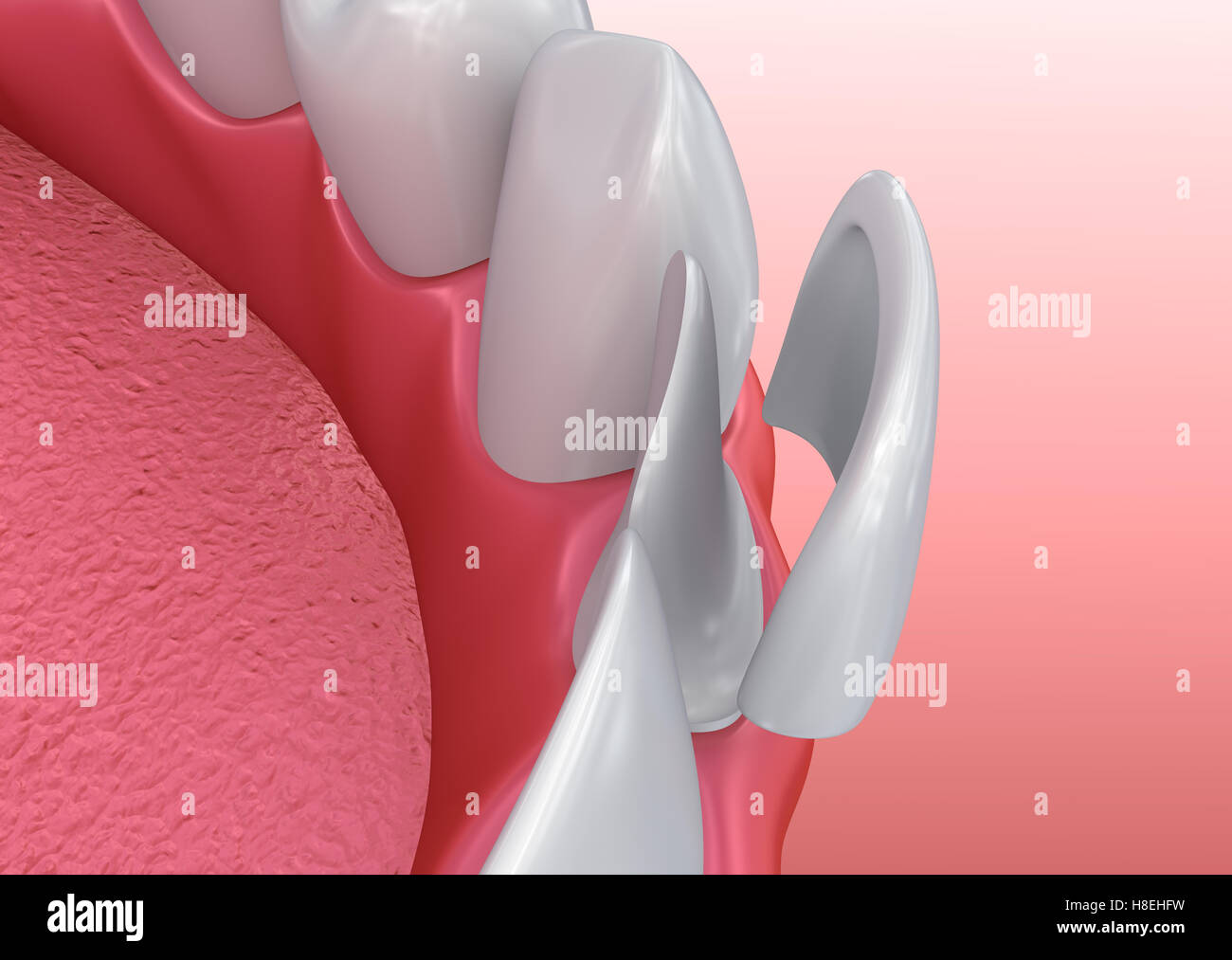 Dental Veneers: Porcelain Veneer installation Procedure. 3D ...