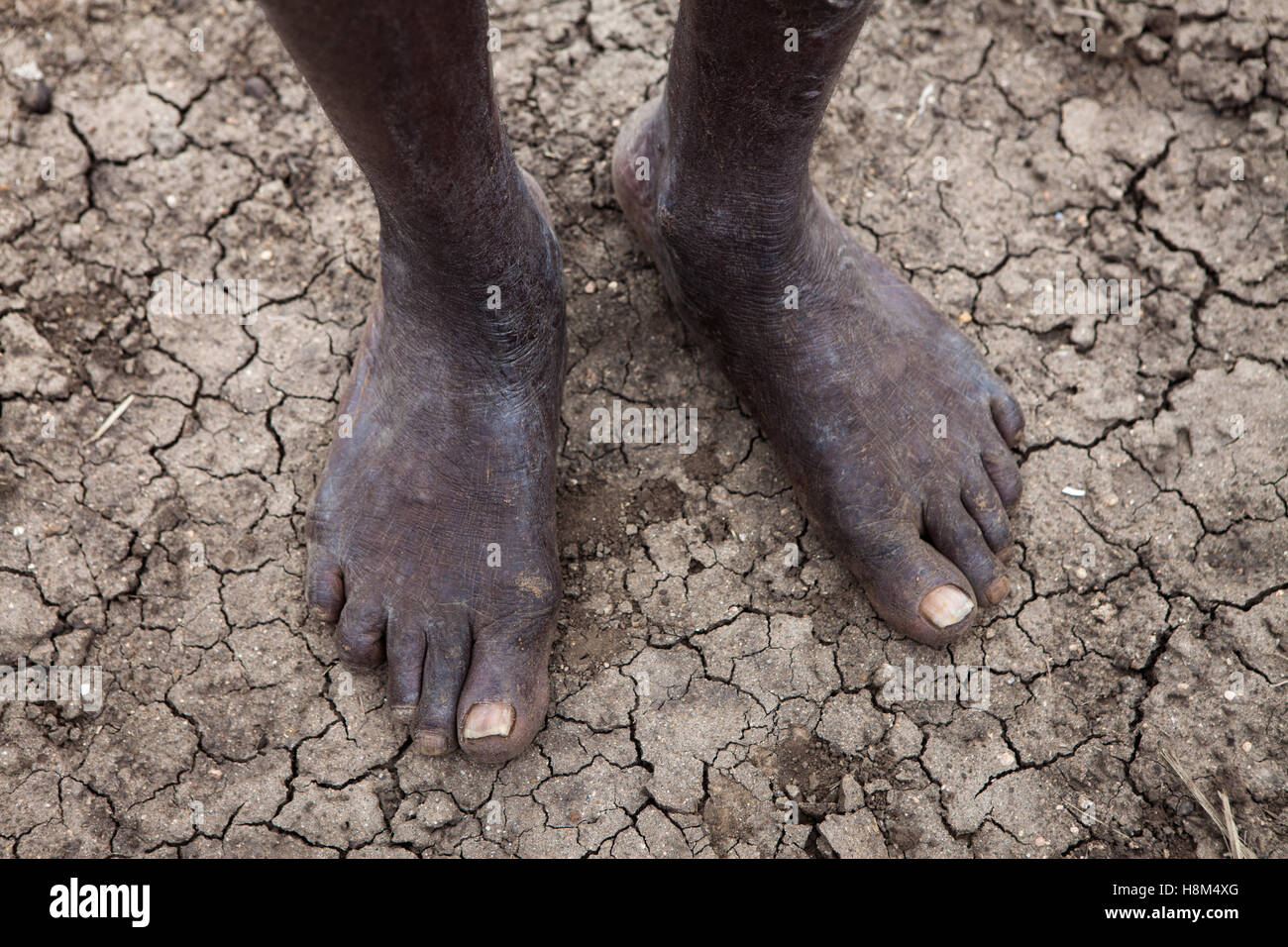 The bare feet of a young African boy on cracked desert earth, in ...