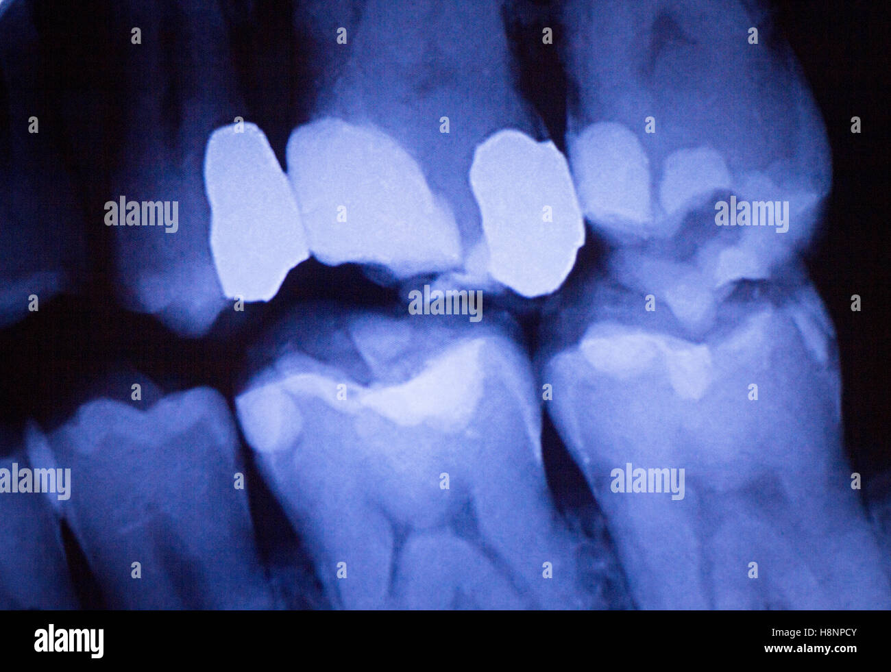 Dentists dental teeth x-ray showing tooth fillings image Stock Photo ...