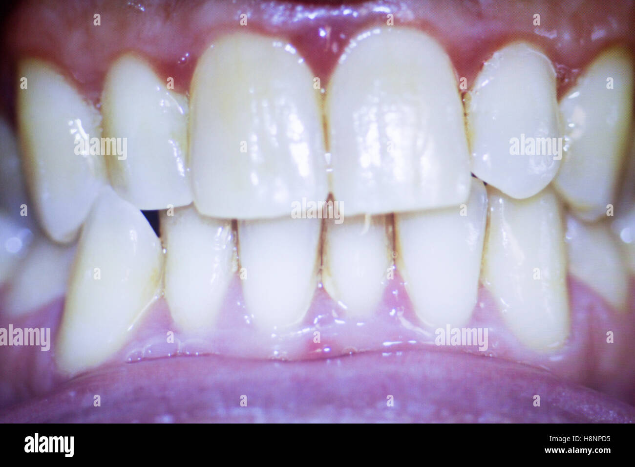 Dentists dental tooth photograph showing tooth non aligned front teeth ...