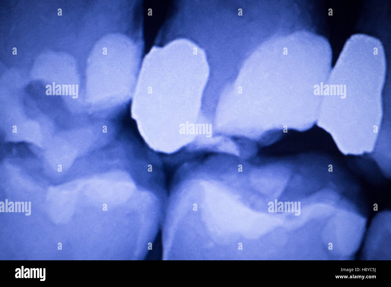 Dentists dental teeth x-ray showing tooth fillings image Stock Photo ...