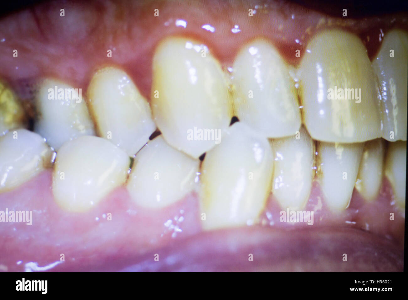 Dentists dental tooth photograph showing tooth non aligned front teeth ...