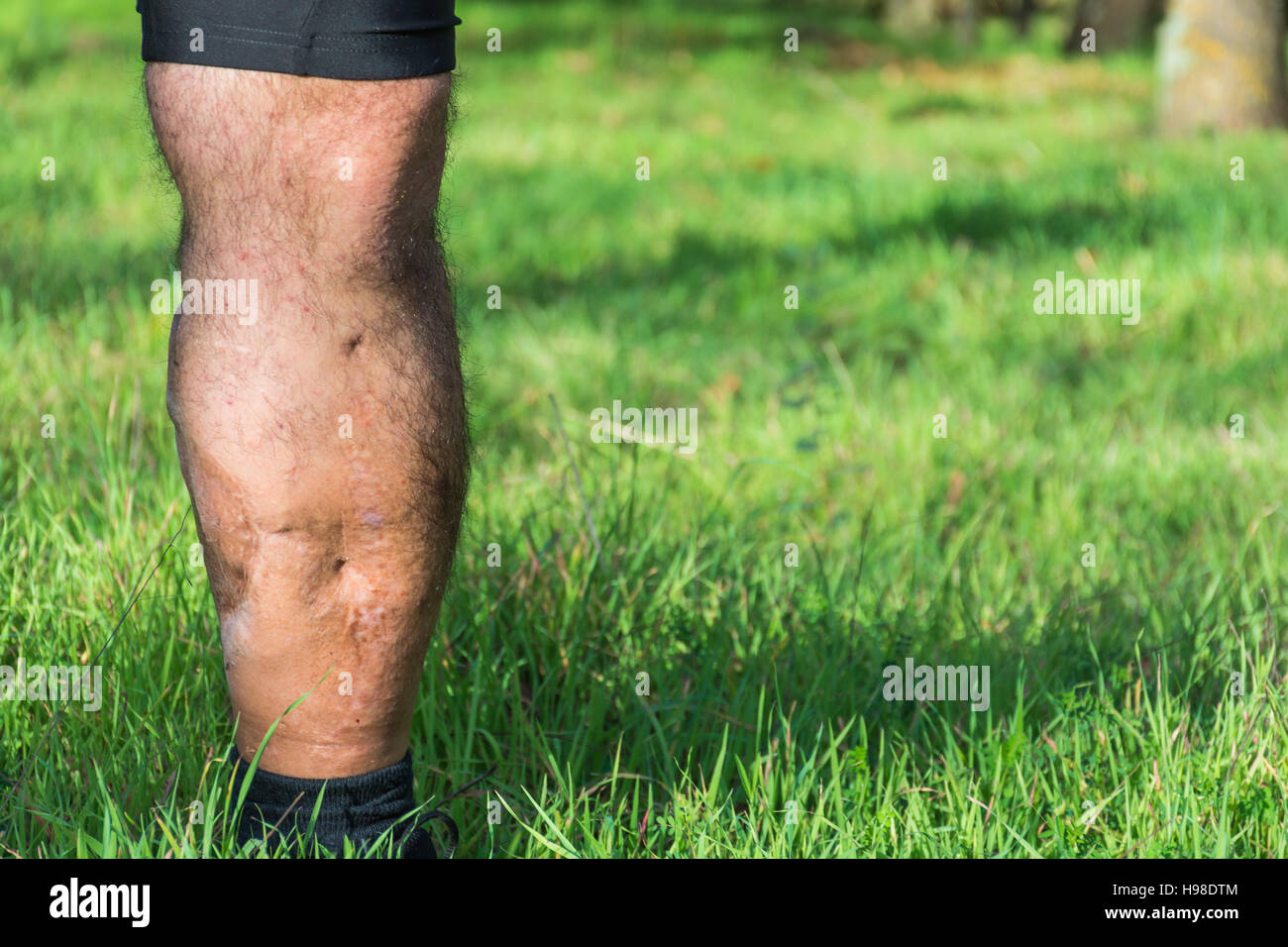 Old scar of leg injury, from car or motorbike accident, deep tissue ...