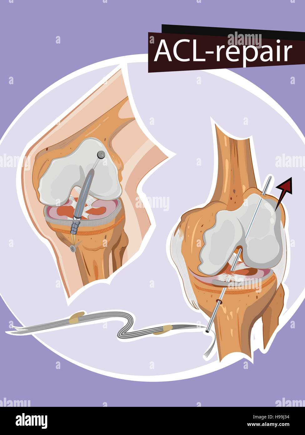 Arthroscopic surgery vector vectors hi-res stock photography and images ...