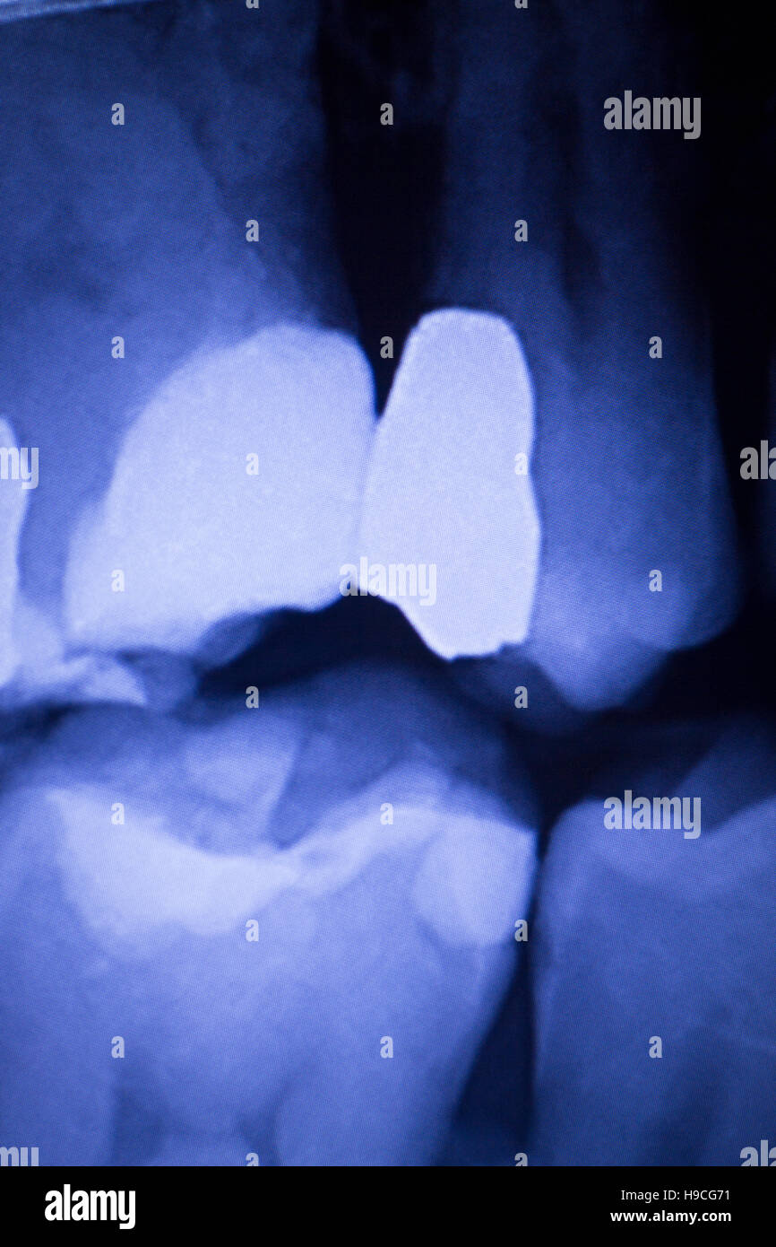 Dentists dental teeth x-ray showing tooth fillings image Stock Photo ...