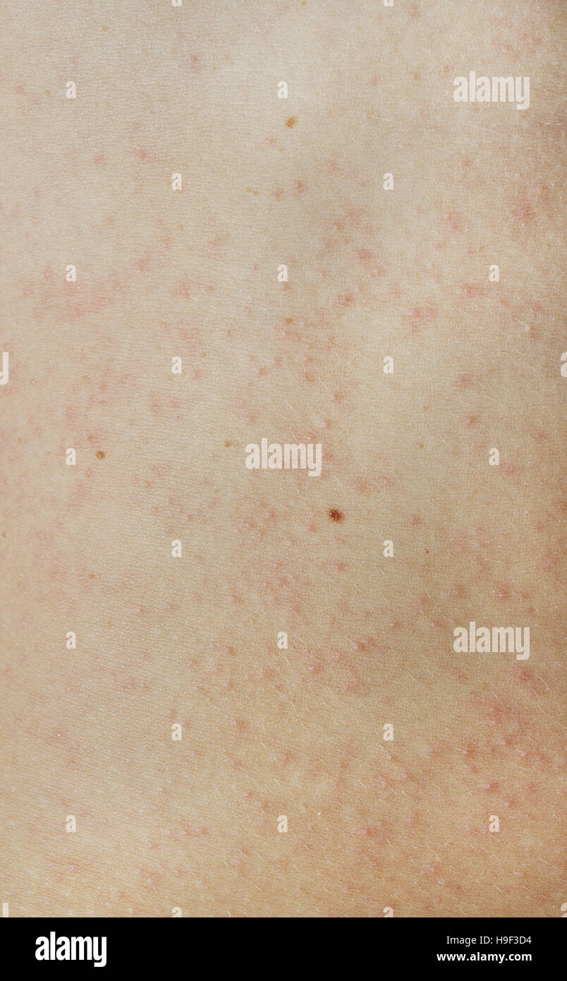 Shingles rash on abdomen hi-res stock photography and images - Alamy