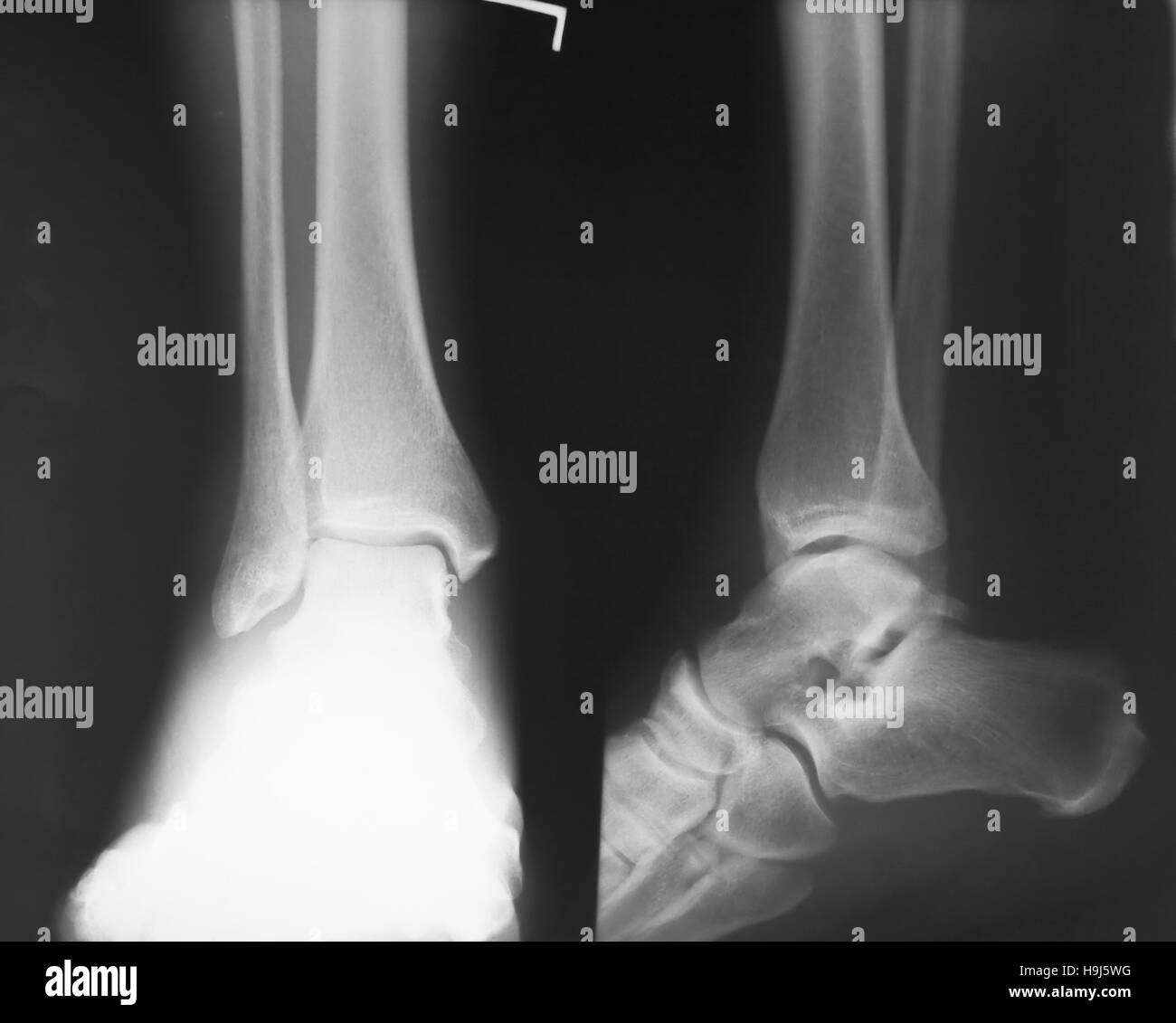 X-ray of human ankle Stock Photo - Alamy