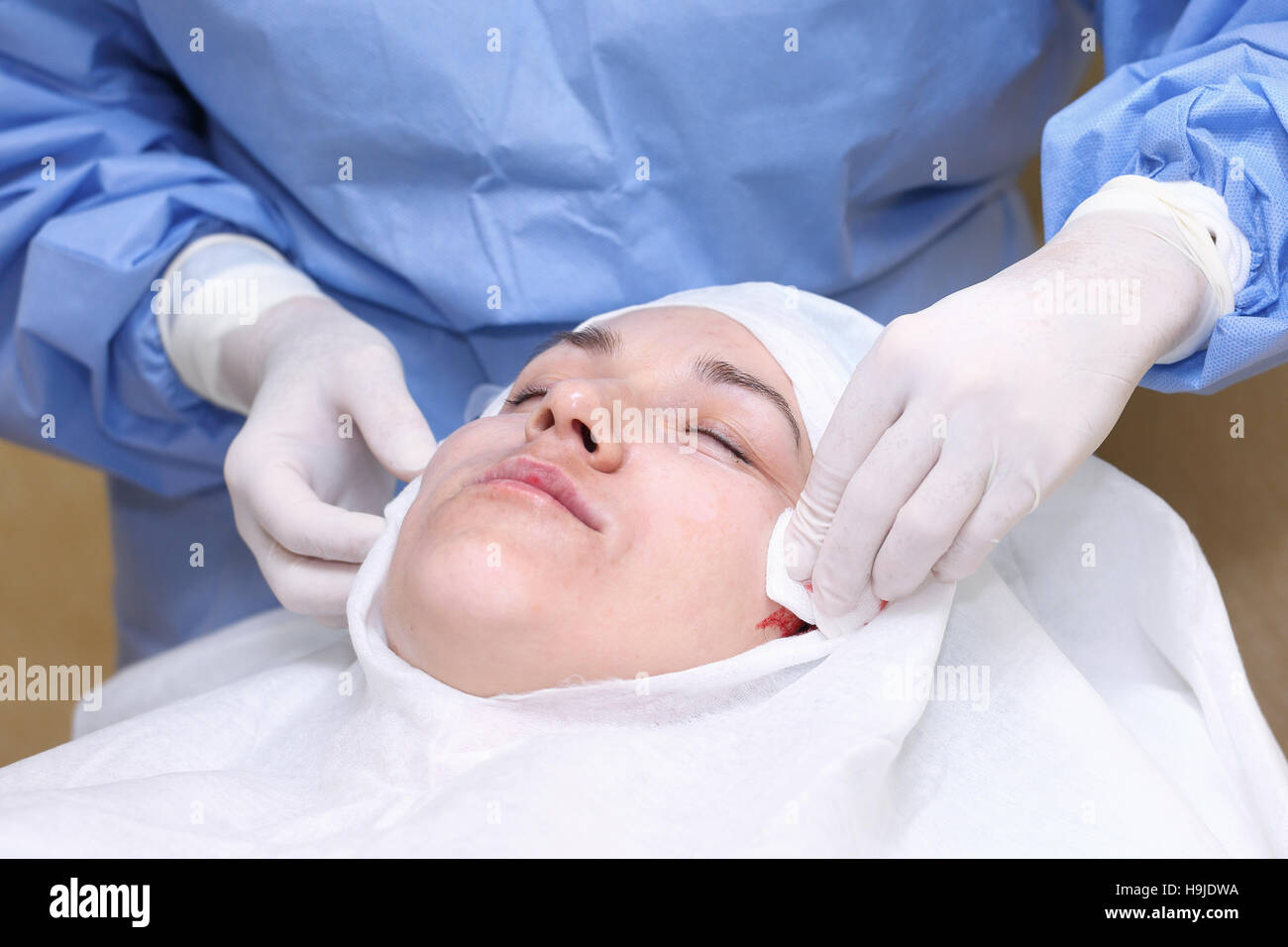 Procedure of face lifting surgery Stock Photo - Alamy