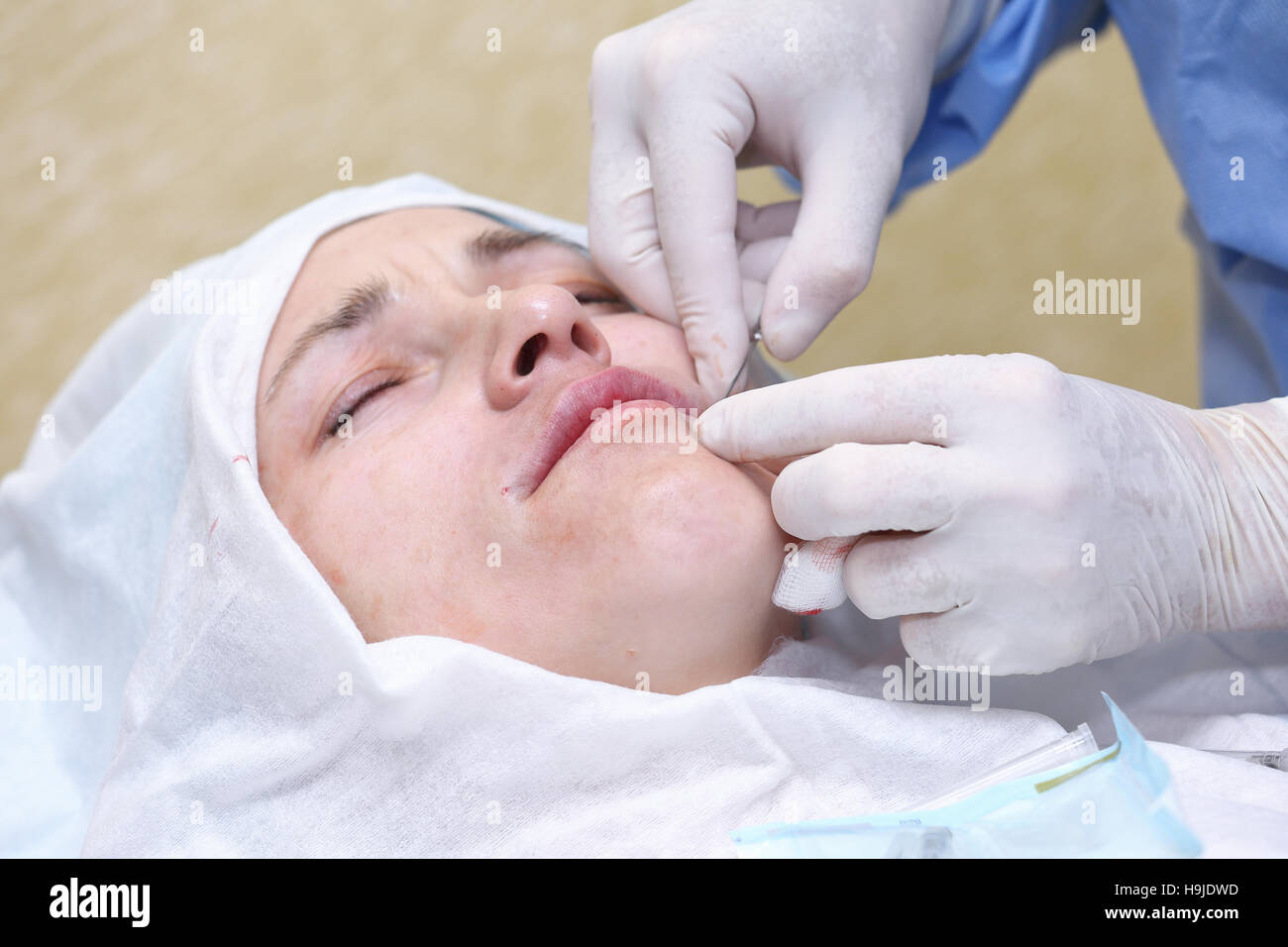 Procedure of face lifting surgery Stock Photo - Alamy