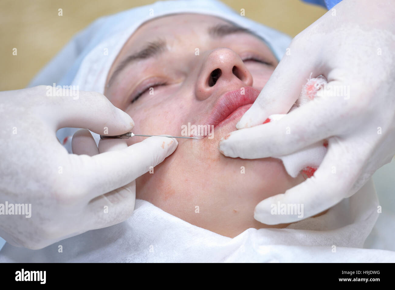 Procedure of face lifting surgery Stock Photo - Alamy