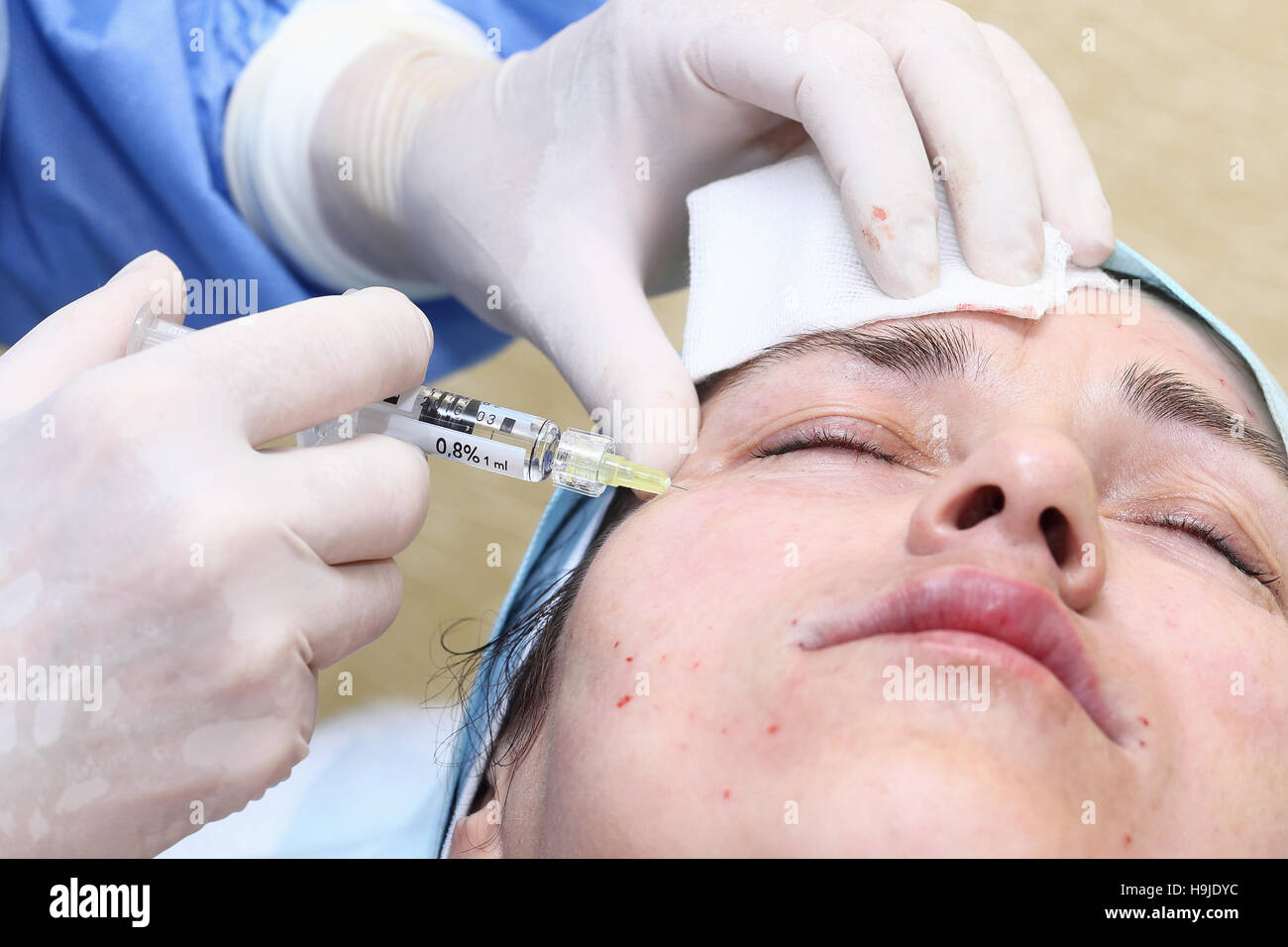 Bio-revitalization with hyaluronic acid treatment of mimic wrinkles ...