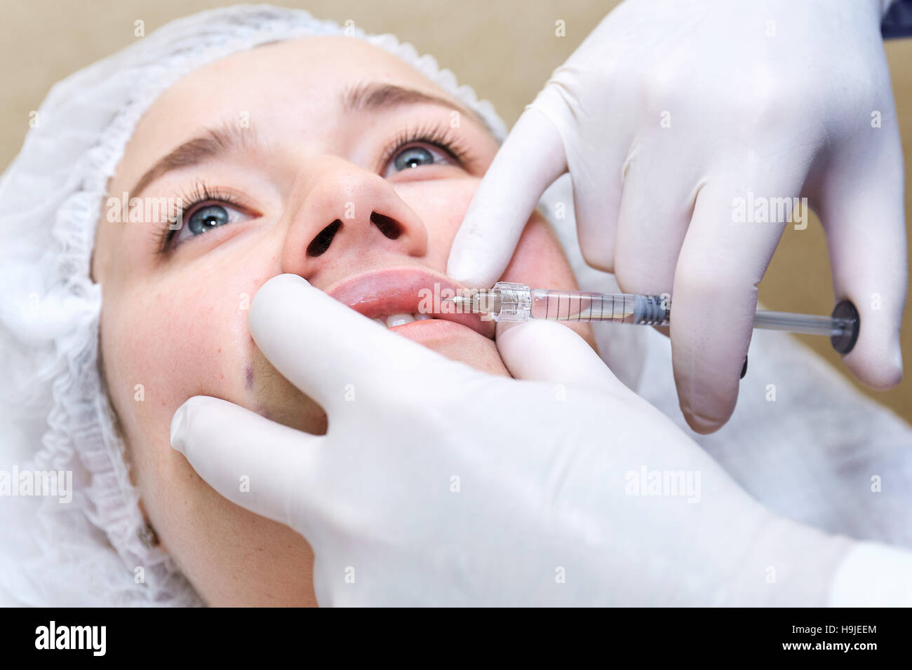 Lip injection procedure. Lips filler. Young woman Stock Photo - Alamy