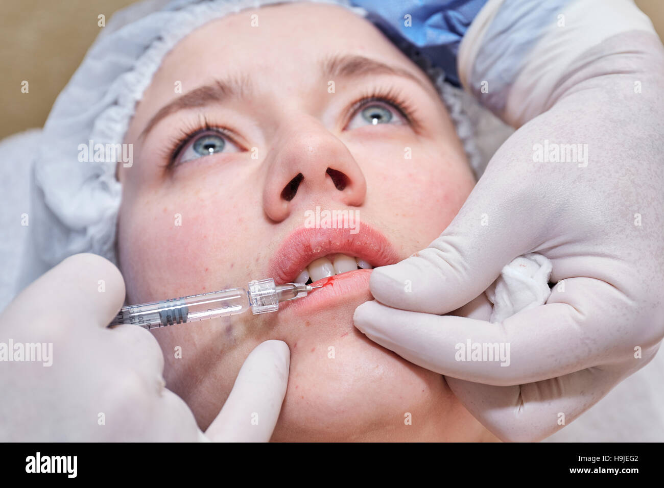 Lip injection procedure. Lips filler. Young woman Stock Photo - Alamy