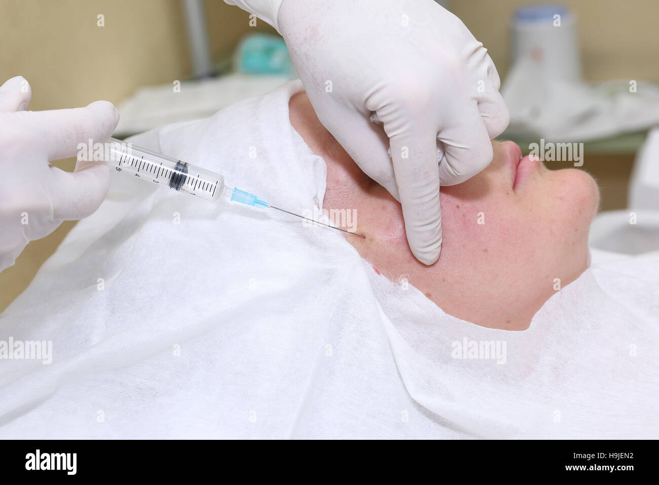 Procedure of face lifting surgery Stock Photo - Alamy