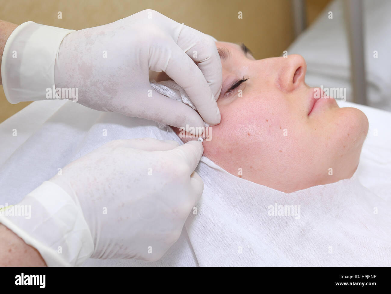 Procedure of face lifting surgery Stock Photo - Alamy