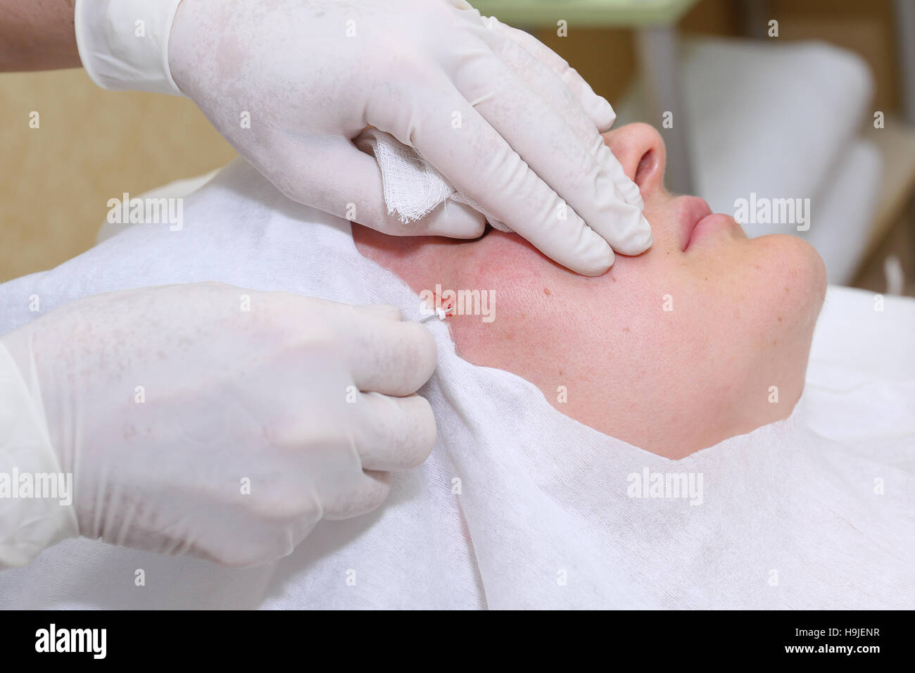 Procedure of face lifting surgery Stock Photo - Alamy