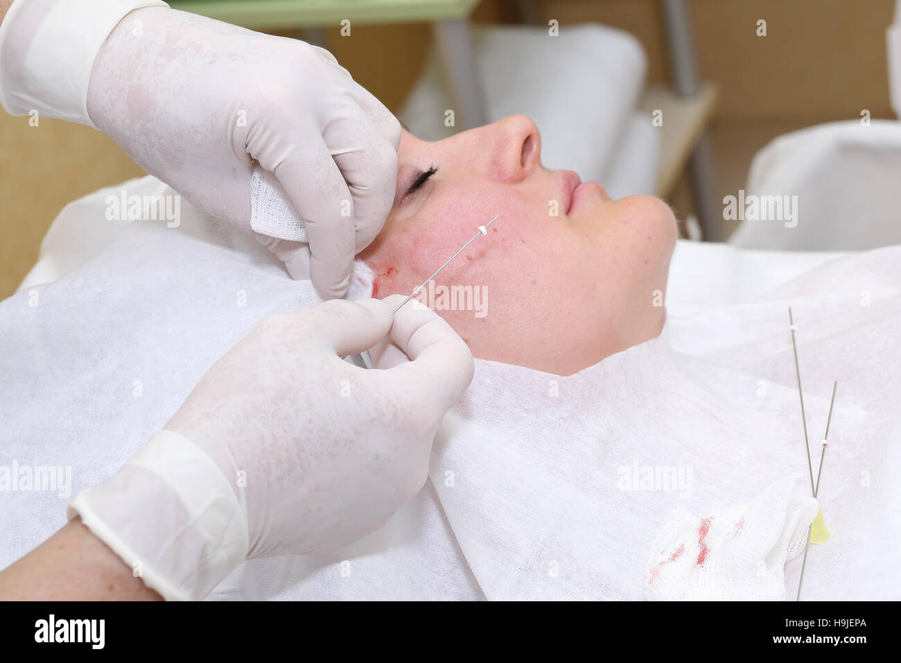 Procedure of face lifting surgery Stock Photo - Alamy