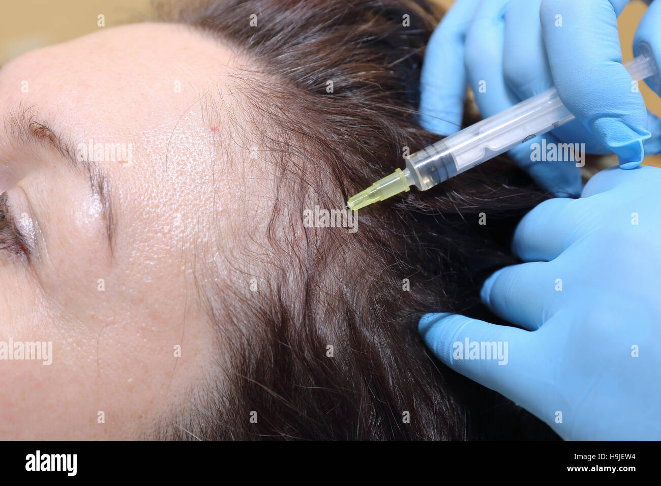 Anti hair loss injection in clinic Stock Photo - Alamy
