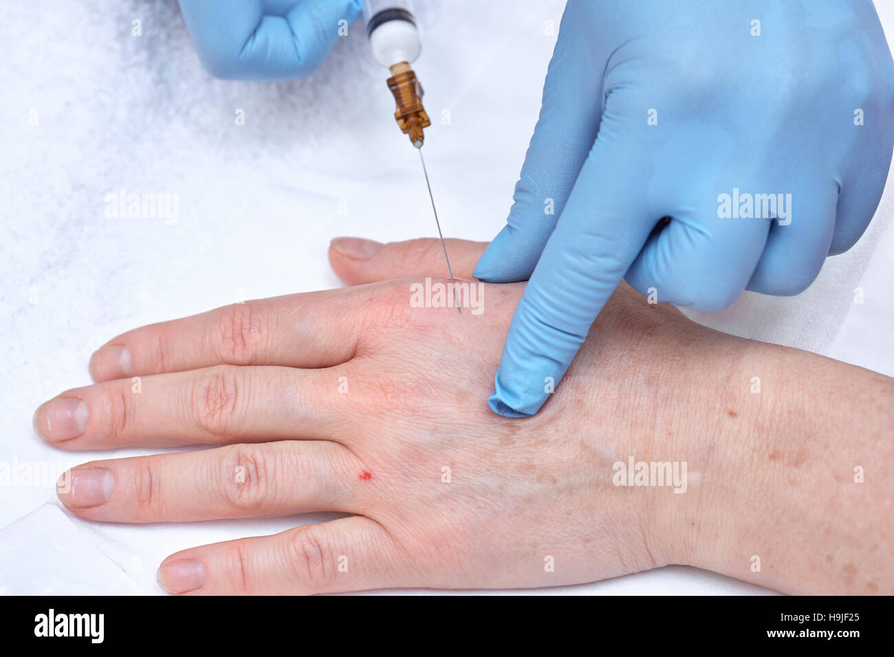 Anti-age injection therapy. Hand rejuvenation Stock Photo - Alamy