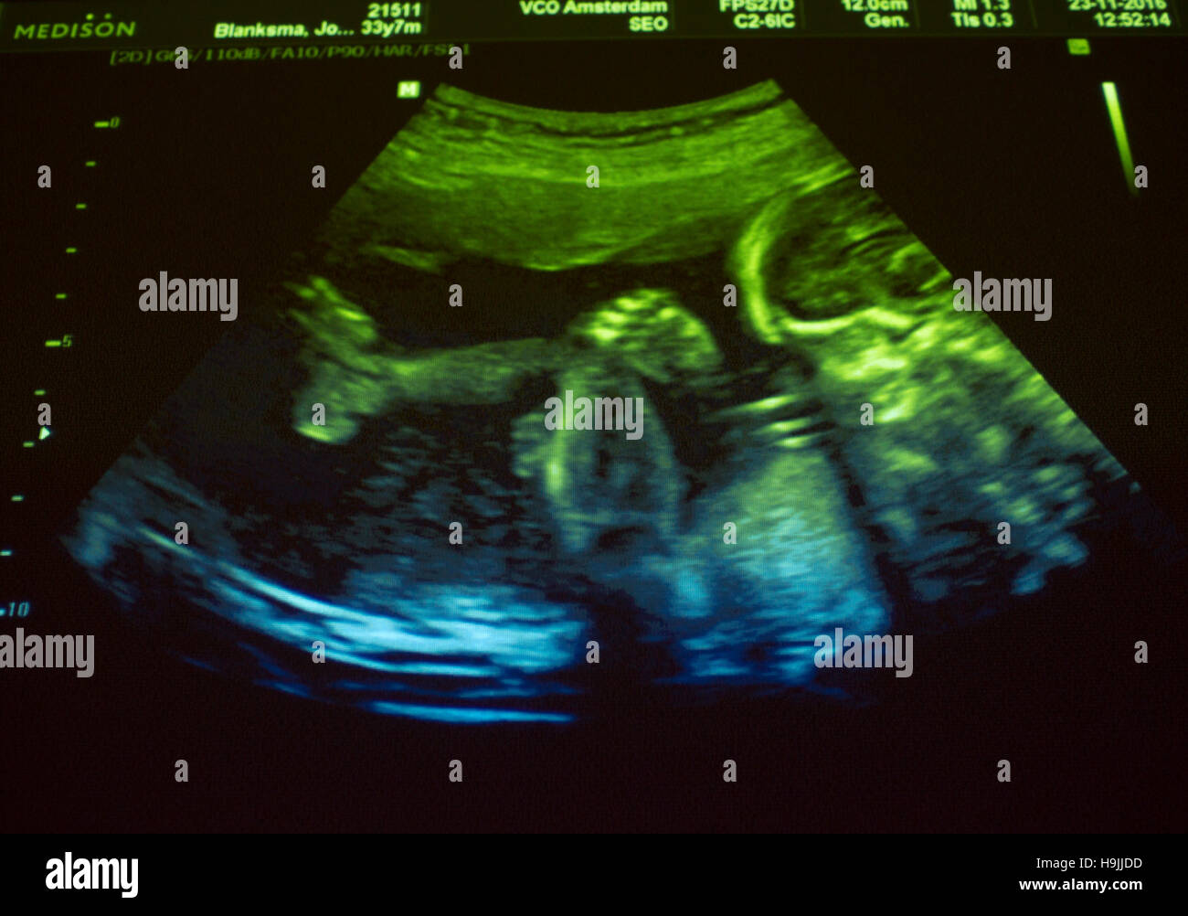 Fetus 20 weeks hi-res stock photography and images - Alamy