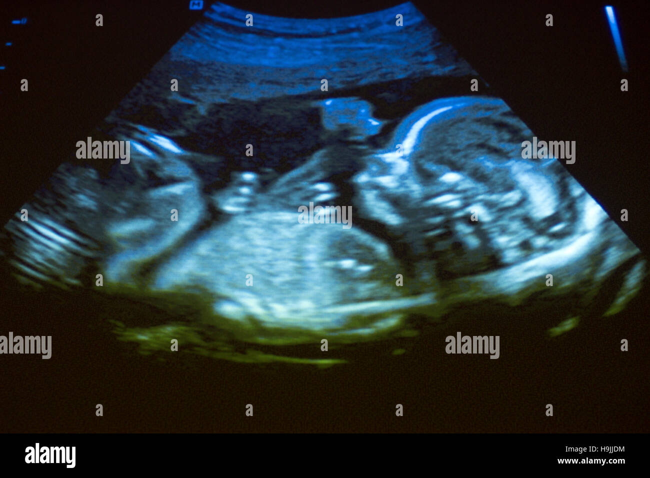 20 week ultrasound scan of pregnant woman Stock Photo - Alamy
