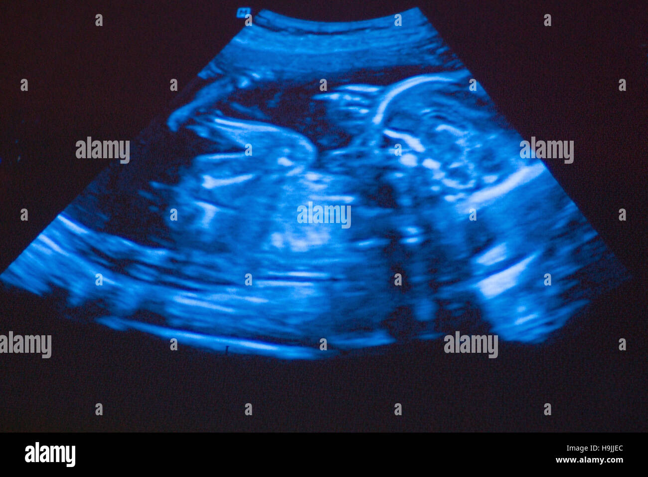 20 week ultrasound scan of pregnant woman Stock Photo - Alamy