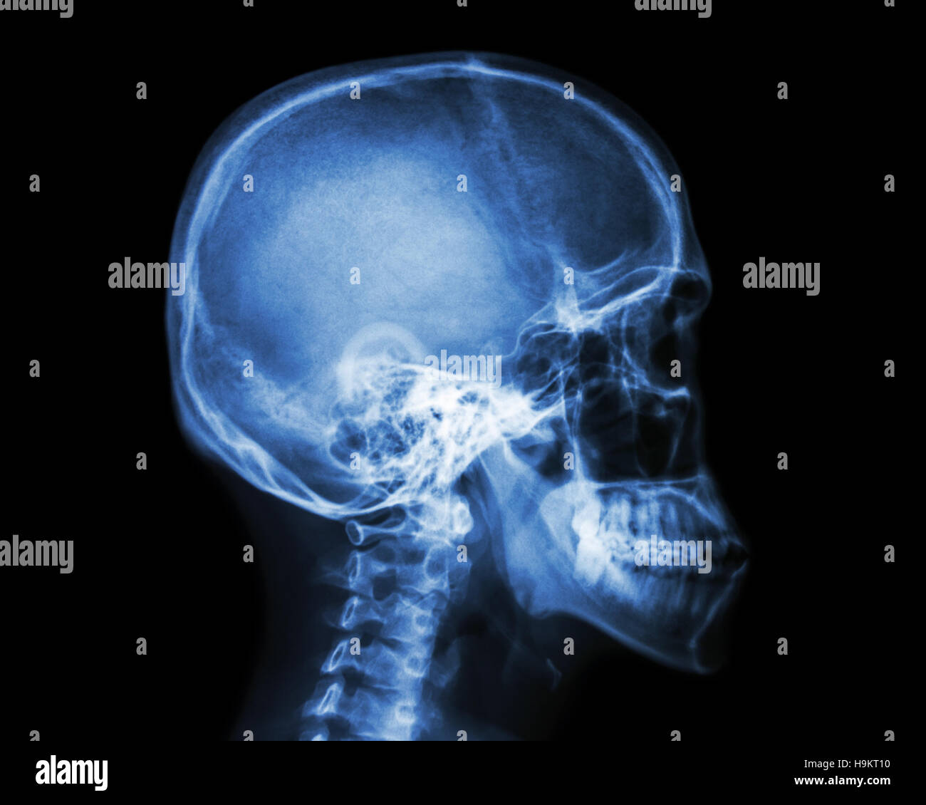 Film x-ray skull and cervical spine lateral view Stock Photo - Alamy