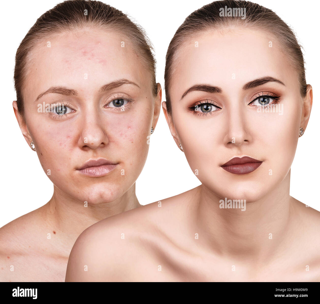 Woman with problem skin on her face Stock Photo - Alamy