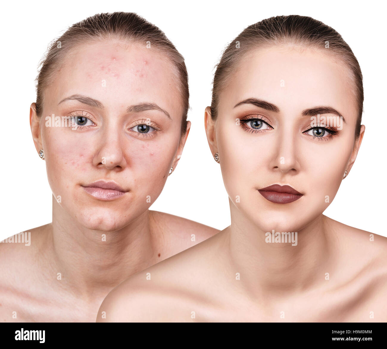 Woman with problem skin on her face Stock Photo - Alamy