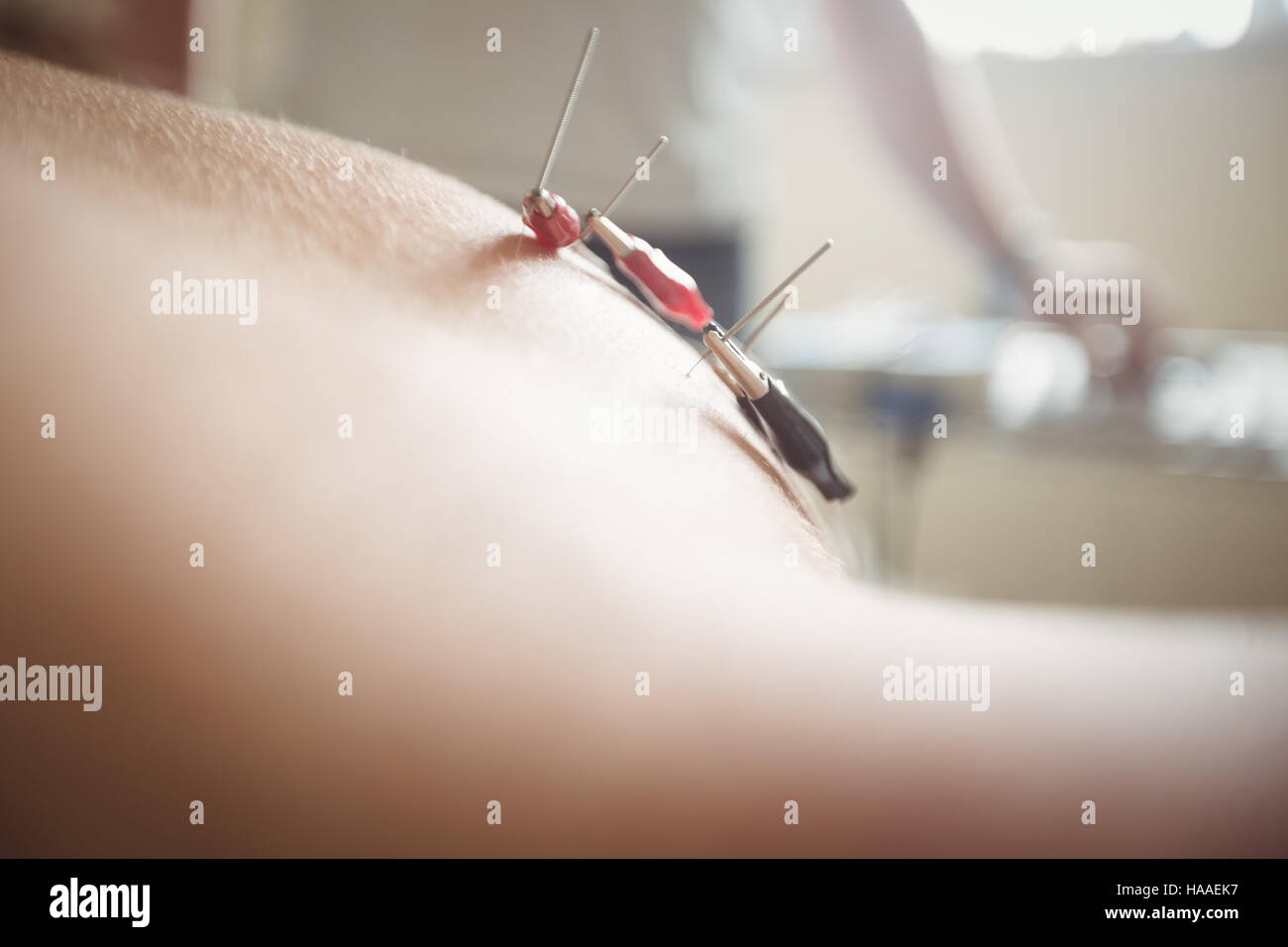 Close-up of patient getting electro dry needling on his shoulder Stock ...