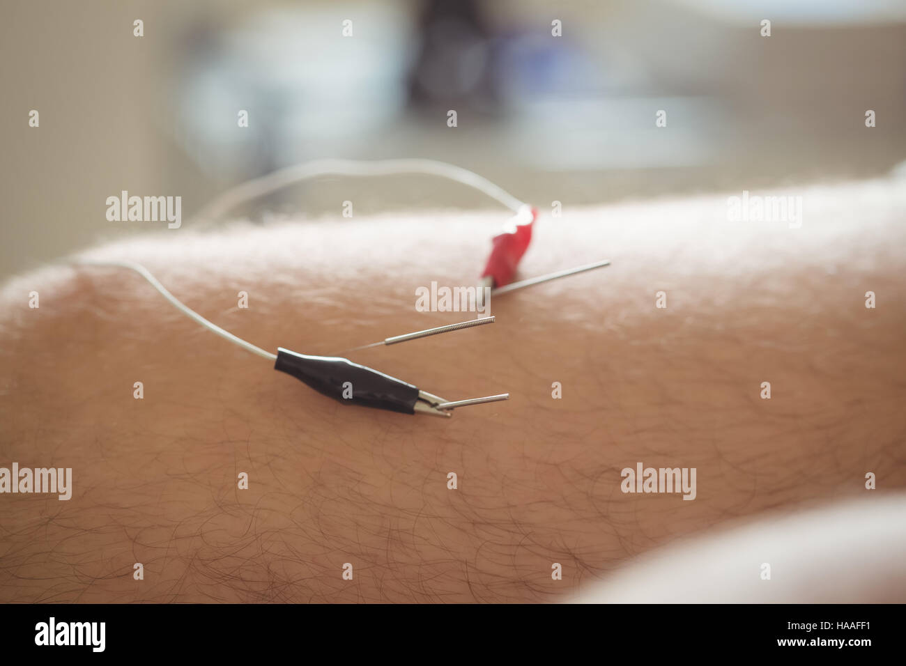 Patient getting electro dry needling on knee Stock Photo - Alamy