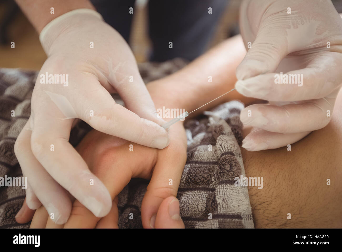 Physiotherapist performing dry needling on the hand of a patient Stock ...