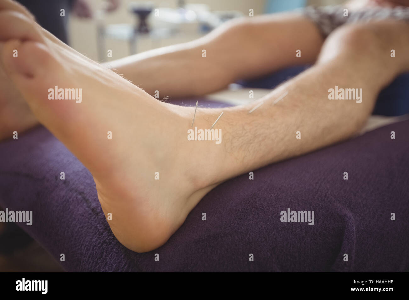 Patient getting dry needling on leg Stock Photo - Alamy
