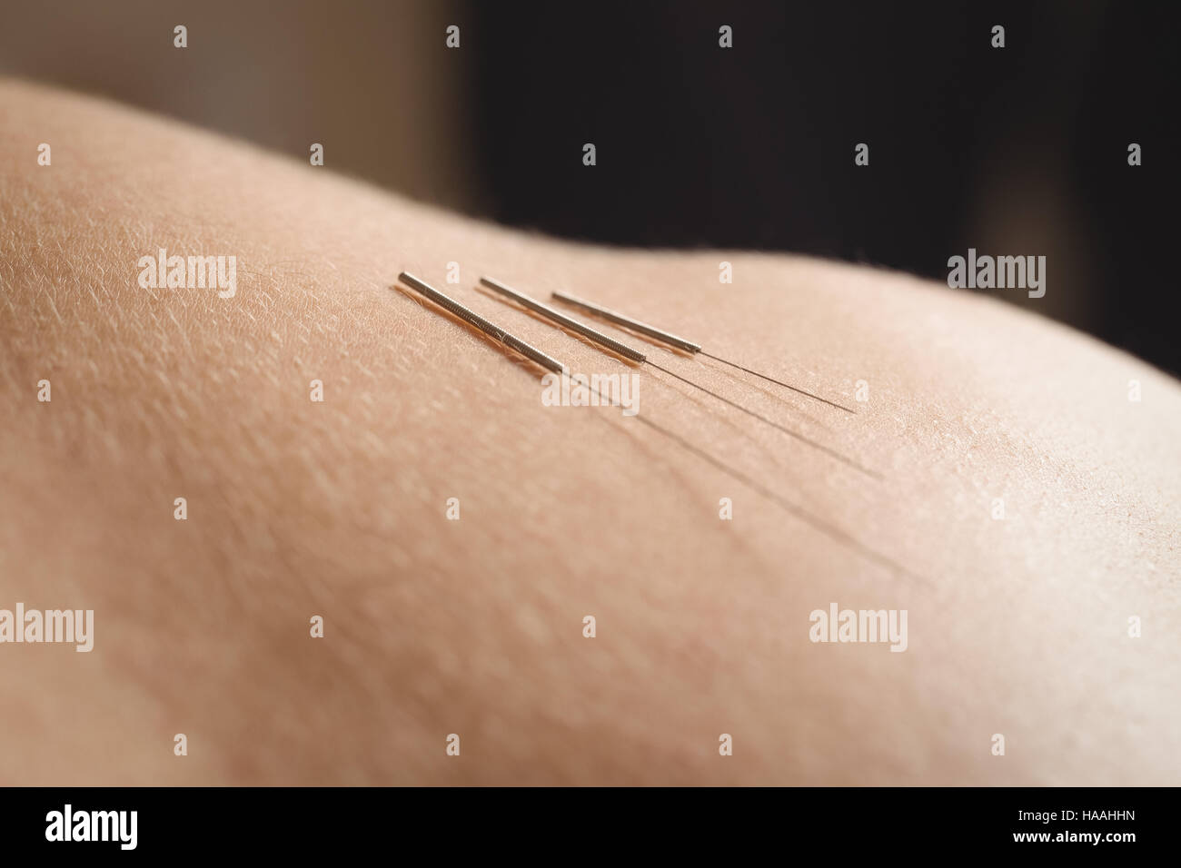 Close-up of needles for dry needling on skin Stock Photo - Alamy