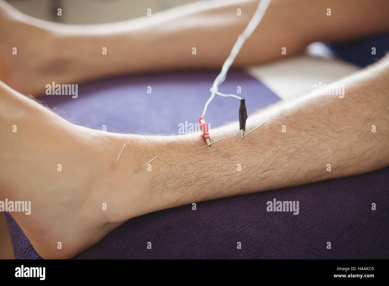 Patient getting electro dry needling on leg Stock Photo - Alamy