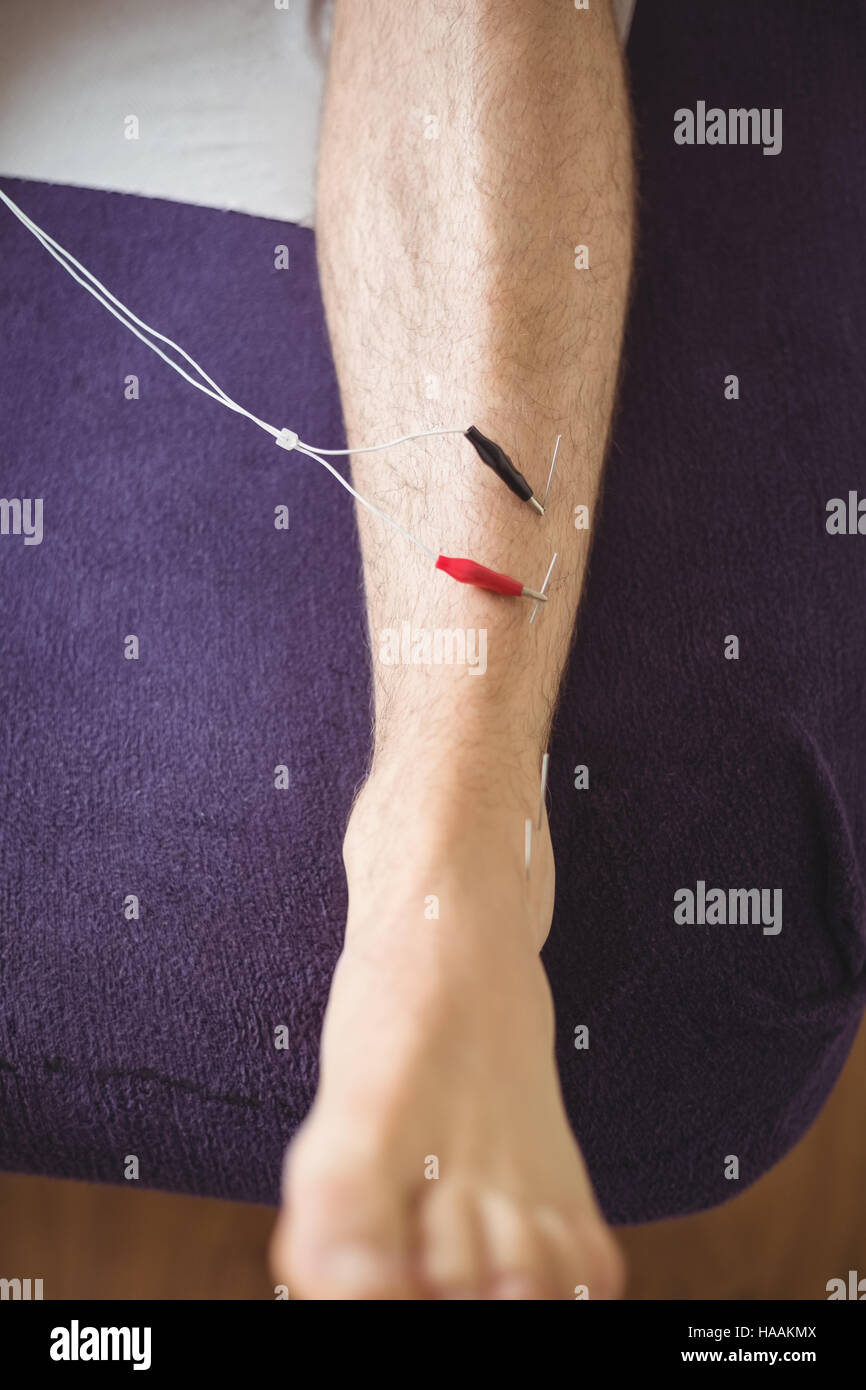 Patient getting electro dry needling on leg Stock Photo - Alamy